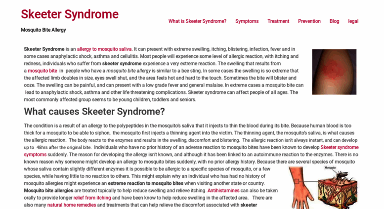 Access skeetersyndrome.net. Mosquito Bite Allergy | Skeeter Syndrome ...
